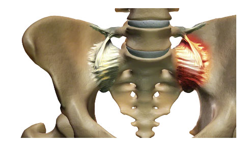 Understanding SI Joint Pain: Diagnosis & Treatment Options